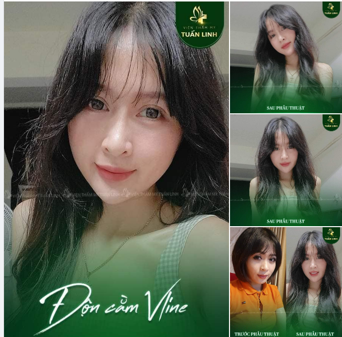 ĐỘN CẰM VLINE - CHO GƯƠNG MẶT THANH TÚ ĐẸP RẠNG NGỜI.