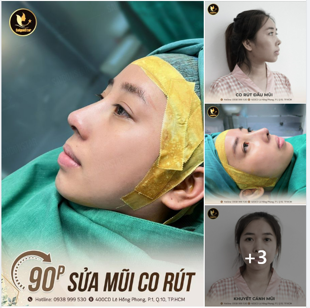 90 PHÚT SỬA MŨI CO RÚT
