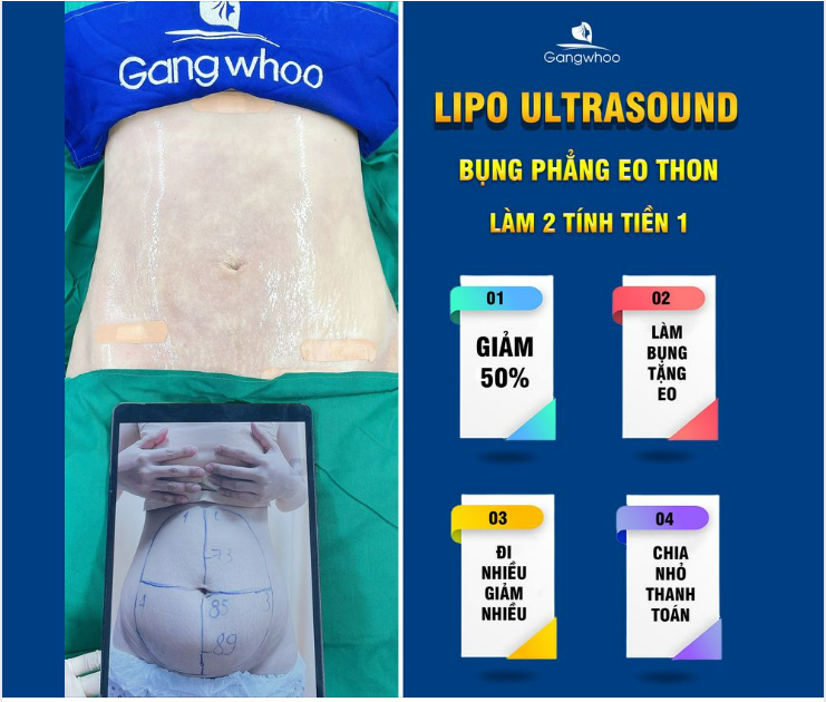 LIPO ULTRASOUND - LÀM 2 TÍNH TIỀN 1