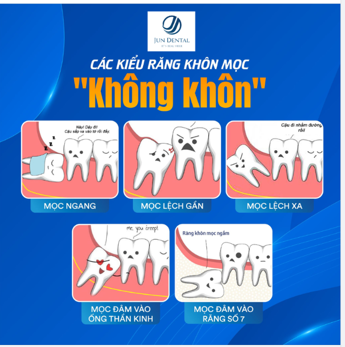 MUÔN KIỂU RĂNG KHÔN MỌC "KHÔNG KHÔN" VÀ NHỮNG HỆ LỤY KHÔNG MONG MUỐN