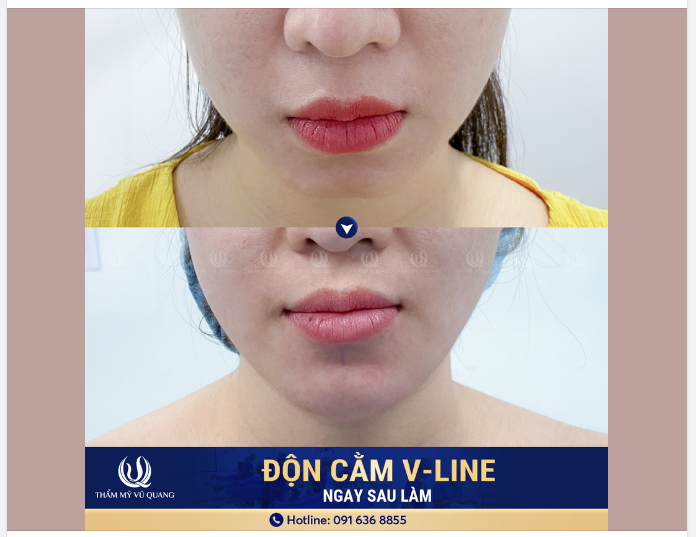 Dáng cằm V-LINE sẽ thay đổi gương mặt bạn như thế nào
