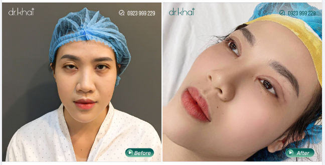 KHẮC PHỤC TÌNH TRẠNG MÍ MẮT LỜ ĐỜ, THIẾU SỨC SỐNG CẮT MÍ TRÊN - CHỈNH ...