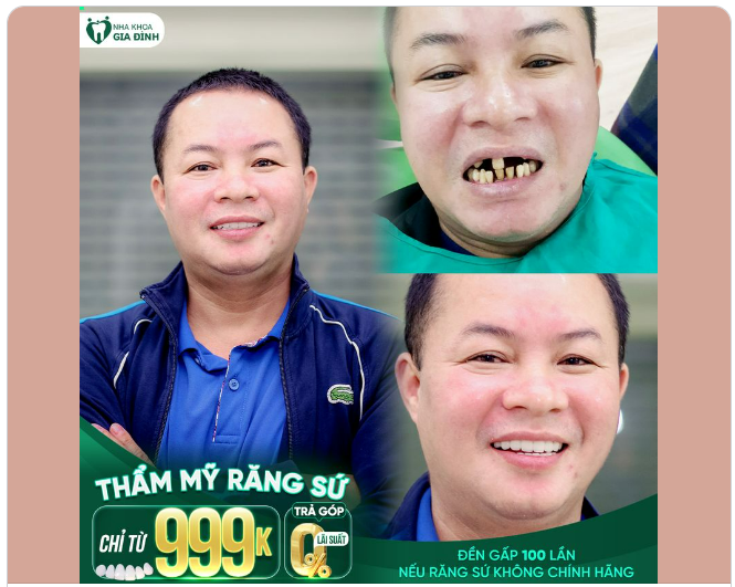 SỨ CHÍNH HÃNG, FORM RĂNG CHUẨN TỈ LỆ CHO VẺ ĐẸP NAM TÍNH