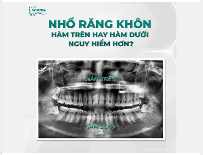 NHỔ RĂNG KHÔN HÀM TRÊN HAY HÀM DƯỚI NGUY HIỂM HƠN?