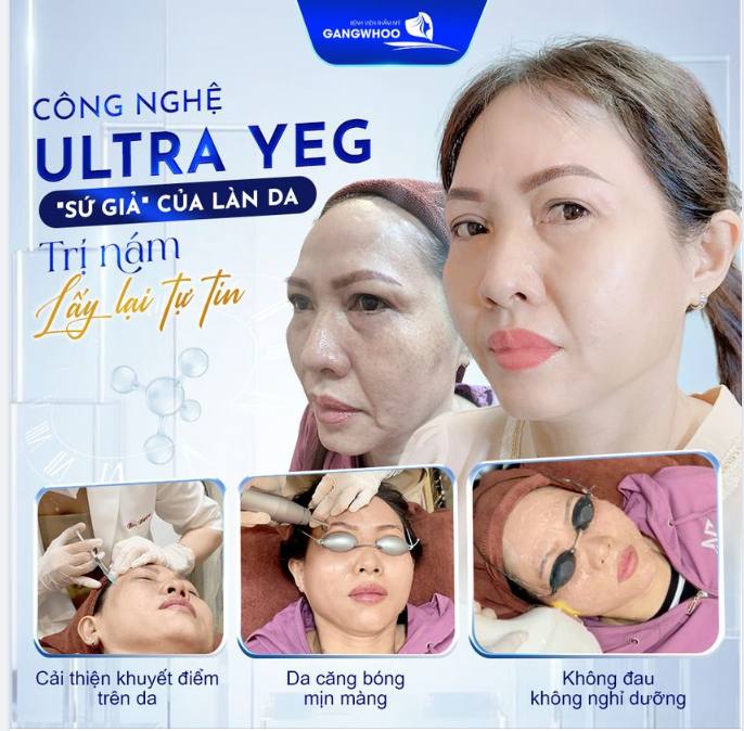 CÔNG NGHỆ ĐIỀU TRỊ NÁM ULTRA YEG
