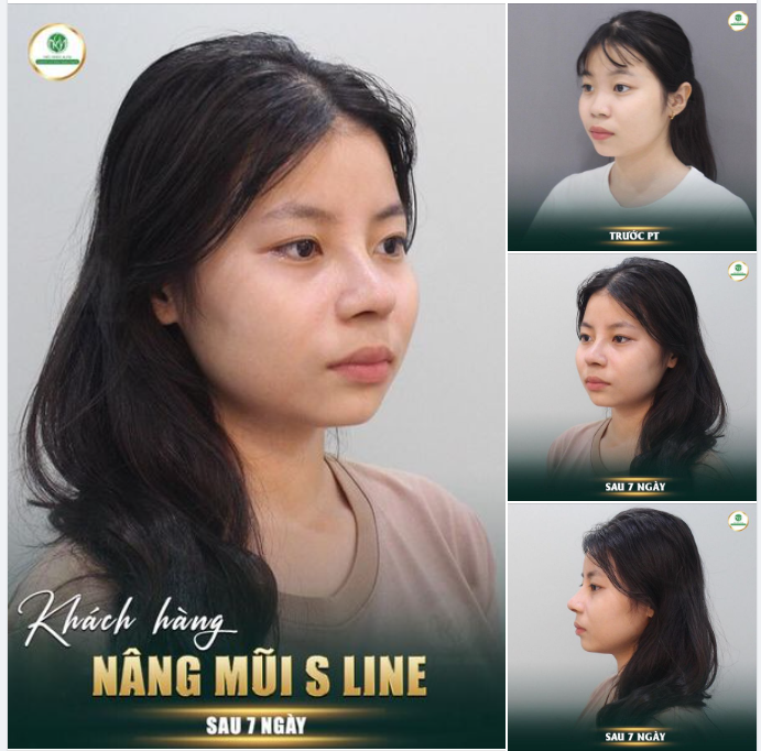 NÂNG MŨI S LINE - DÁNG THỜI THƯỢNG TƯỚNG CAO SANG