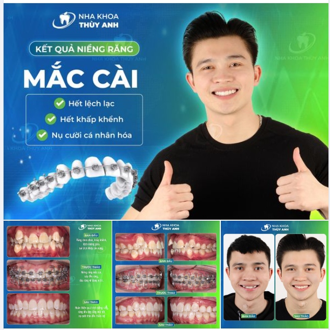 CHIA TAY HÀM RĂNG KHẤP KHỂNH, NAM KHÁCH HÀNG THAY ĐỔI NGỠ NGÀNG SAU ...