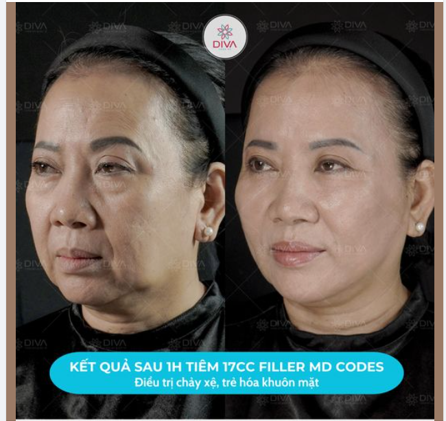 KẾT QUẢ SAU 1H TIÊM 17CC FILLER MD DYNAMIC CODES ĐIỀU TRỊ CHẢY XỆ, TRẺ ...