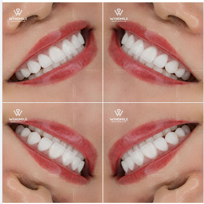 NÂNG TẦM VẺ ĐẸP NGỌT NGÀO TỪ FORM RĂNG TỰ NHIÊN