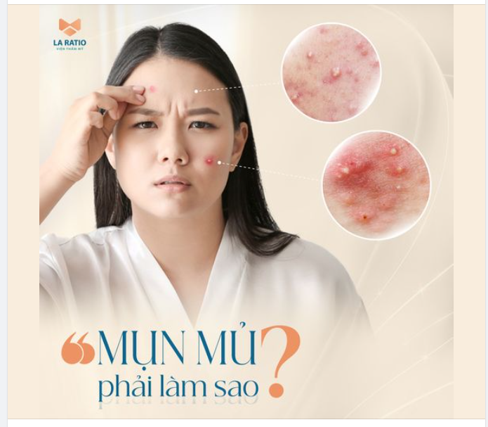 Có MỤN MỦ trên mặt xử lý thế nào?