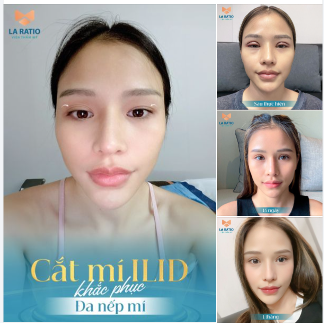 Cắt mí ILID - Cứu tinh của đôi mắt đa nếp mí