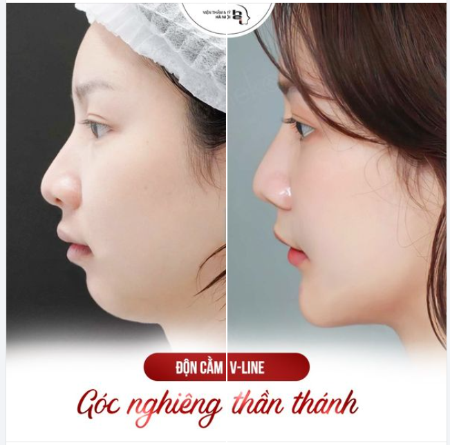 ĐỘN CẰM VLINE GÓC NGHIÊNG THẦN THÁNH