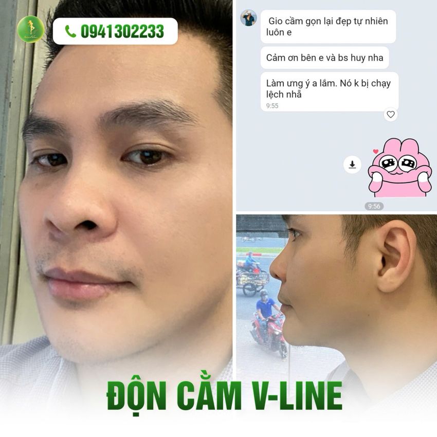 FEEDBACK CHIẾC CẰM V-LINE NAM TÍNH CHO KHÁCH HÀNG GẶP TÌNH TRẠNG CẰM LẸM
