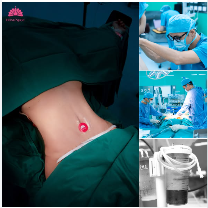 "ĐÁNH BAY" MỠ THỪA - LẤY LẠI VÓC DÁNG "NÀNG THƠ"