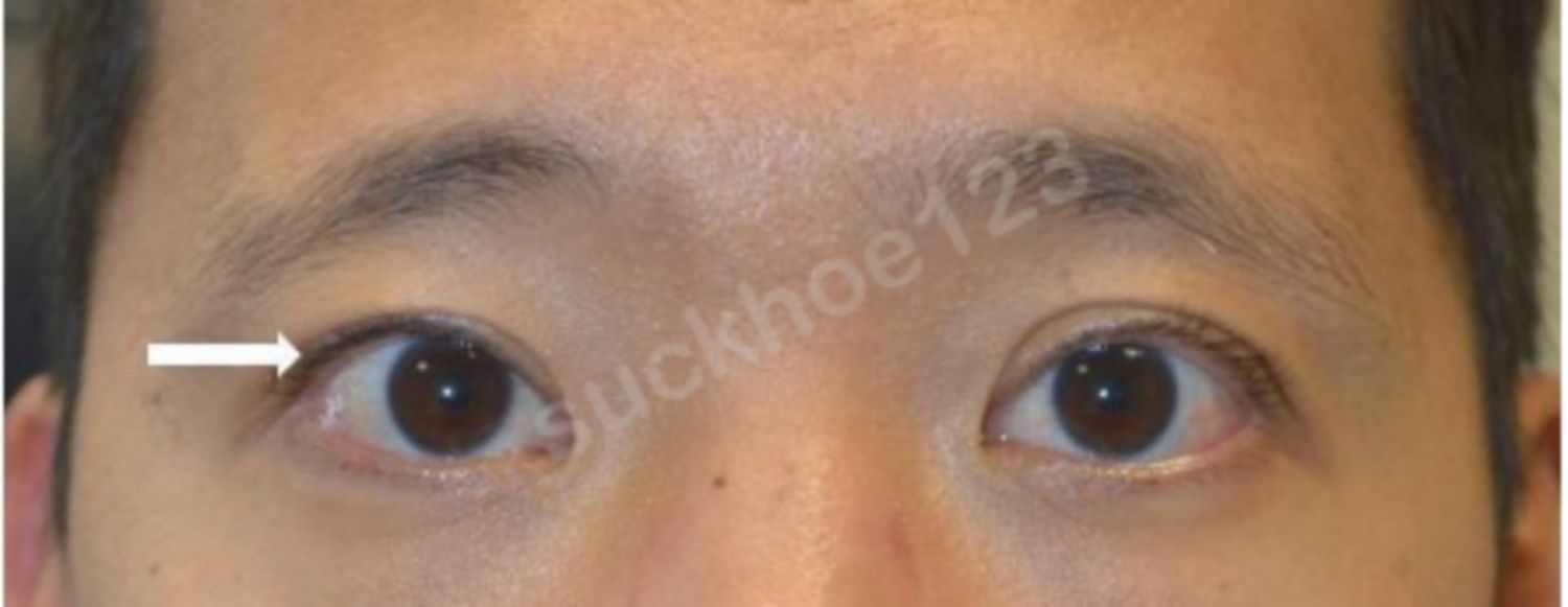 Cắt mí mắt bị trợn nguyên nhân do đâu, có sửa được không?