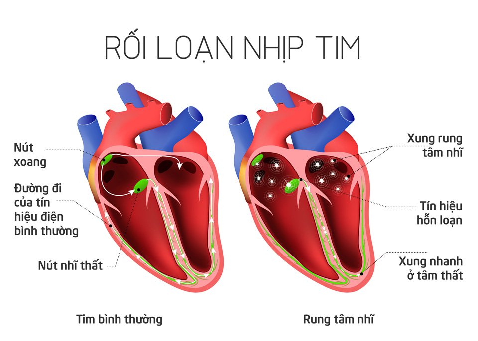 Máy tạo nhịp tim tạm thời