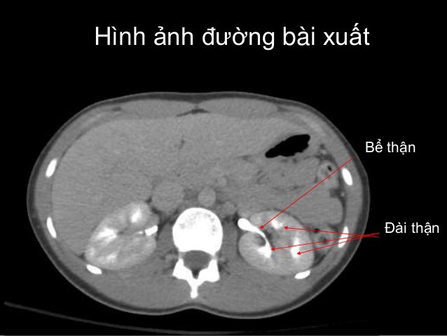Trước khi chụp CLVT hệ tiết niệu thường quy người bệnh nên chuẩn bị gì?