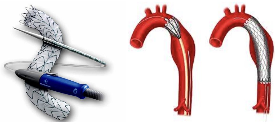 Đặt stent phình động mạch chủ - Bộ y tế 2014
